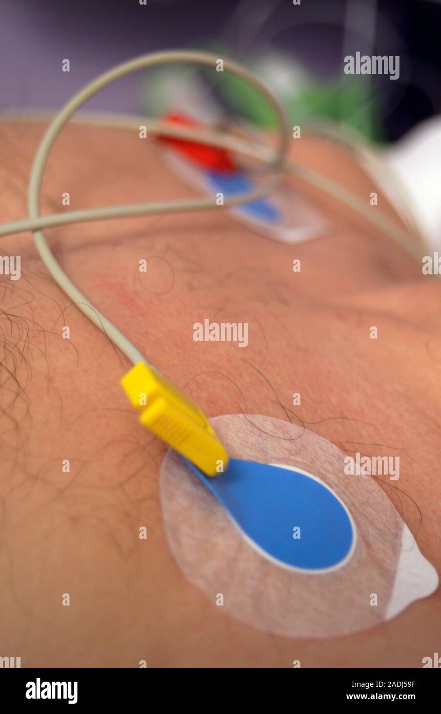 Les électrodes ECG à la poitrine du patient. L'électrocardiographie ...