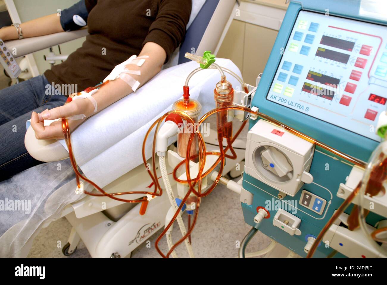 L'appareil de dialyse. Patient attaché à un appareil de dialyse, ou ...