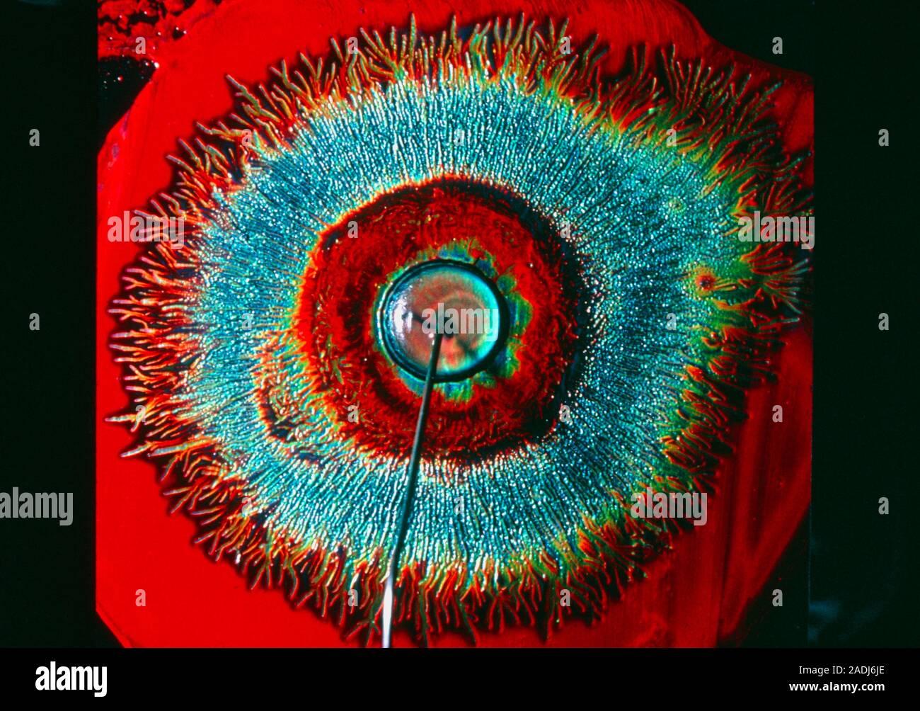 Le cancer du côlon de sang. L'image de champ électrique d'un ...