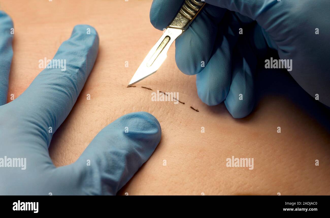 Première incision. Surgeon making la première incision à l'aide d'un ...
