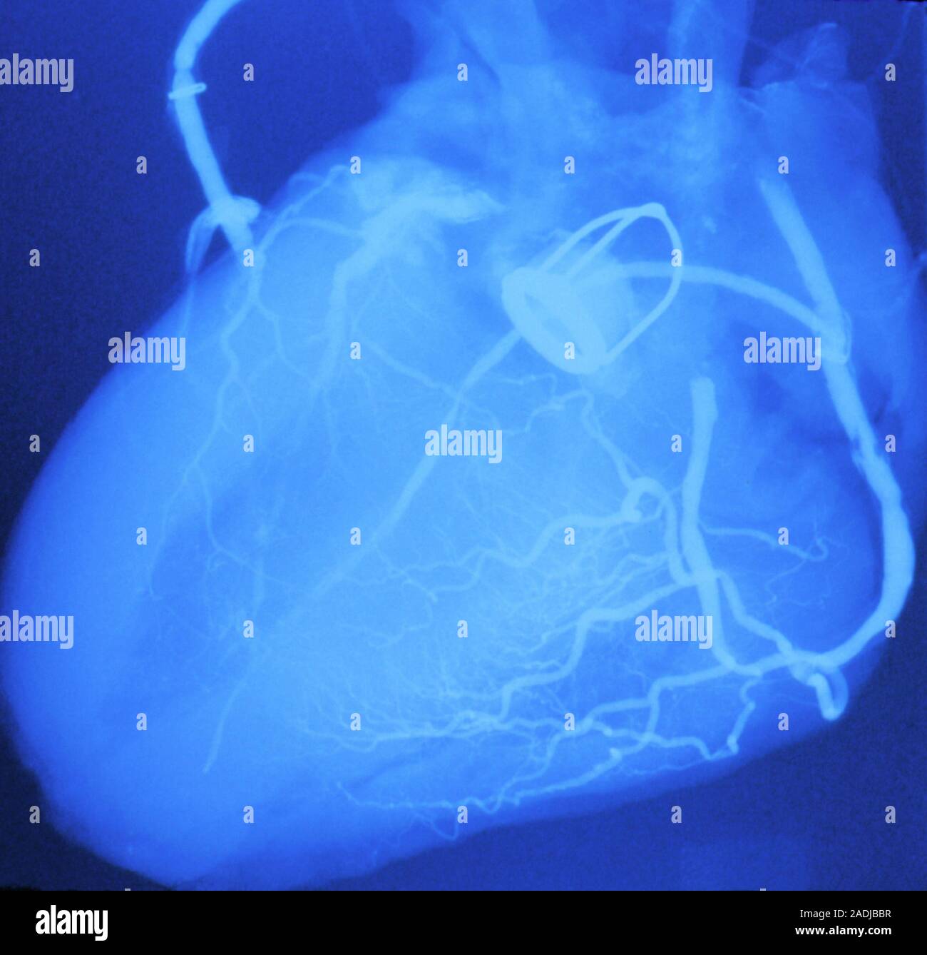 Angiogramme en fausses couleurs (X-ray image) du cœur de l'homme ...