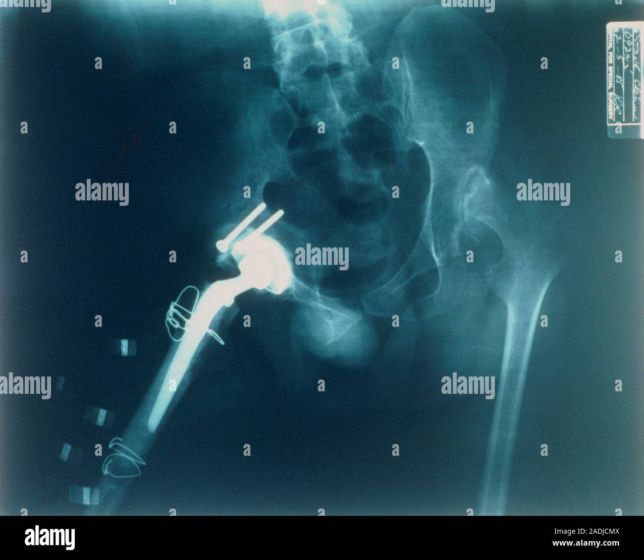 Radiographie de la région pelvienne après chirurgie pour remplacer le ...