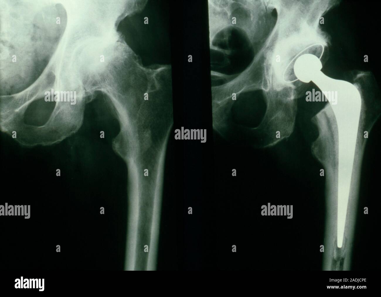 Remplacement de la hanche. X-ray images prises avant et après une ...