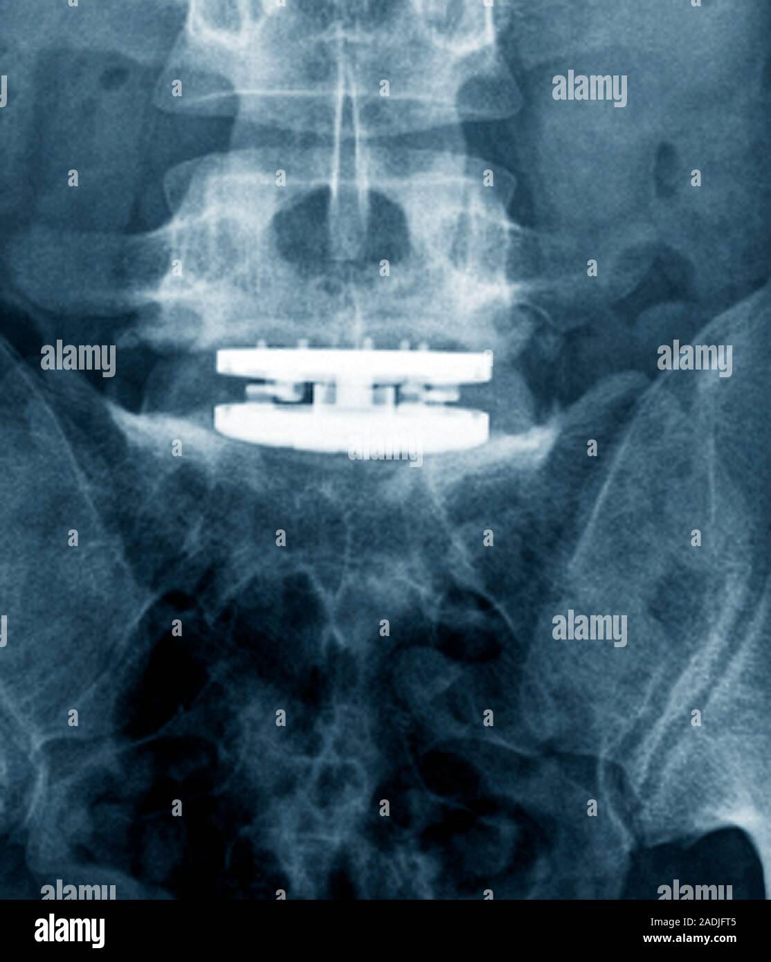 L'os, l'implant intervertébral X-ray. Vue frontale d'un implant osseux ...