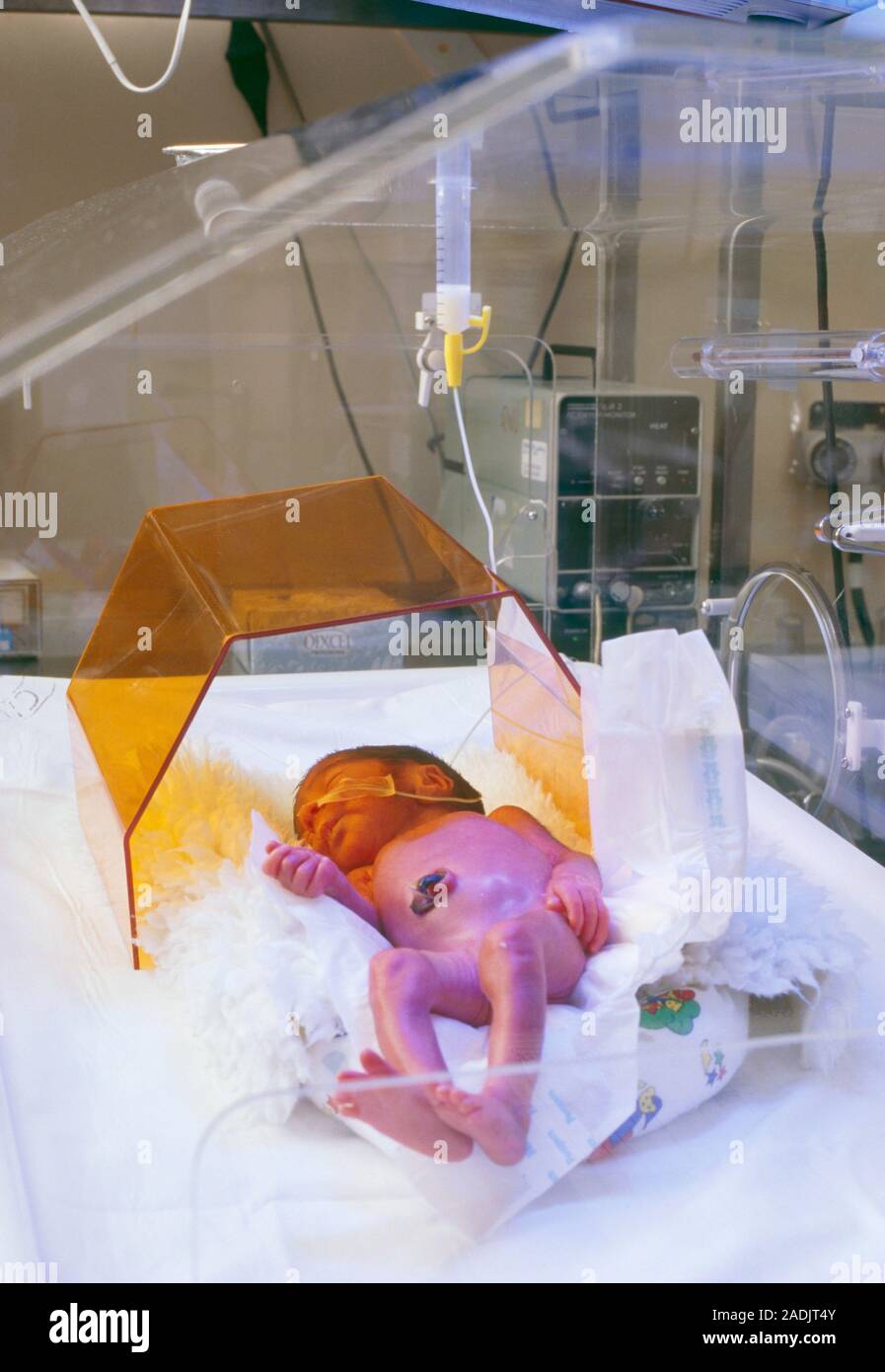 Parution du modèle. Traitement de l'ictère néonatal. Bébé dans un ...