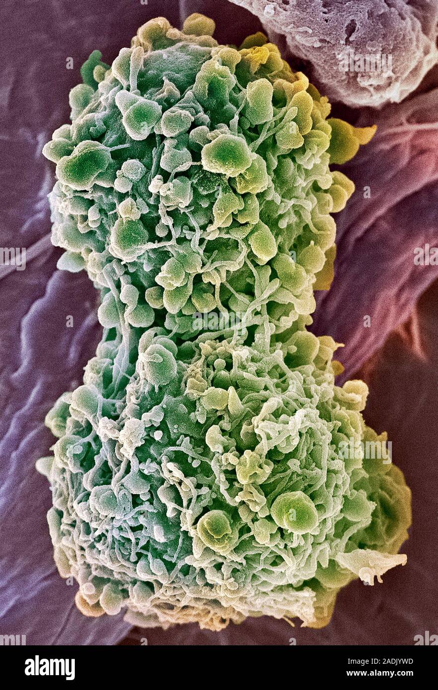 Les cellules du cancer du col de la division. Couleur de l'analyse des ...