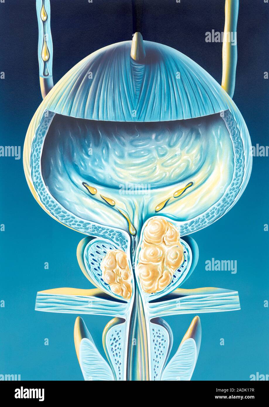 Élargissement de la prostate. Artwork d'une glande de prostate (Brown ...