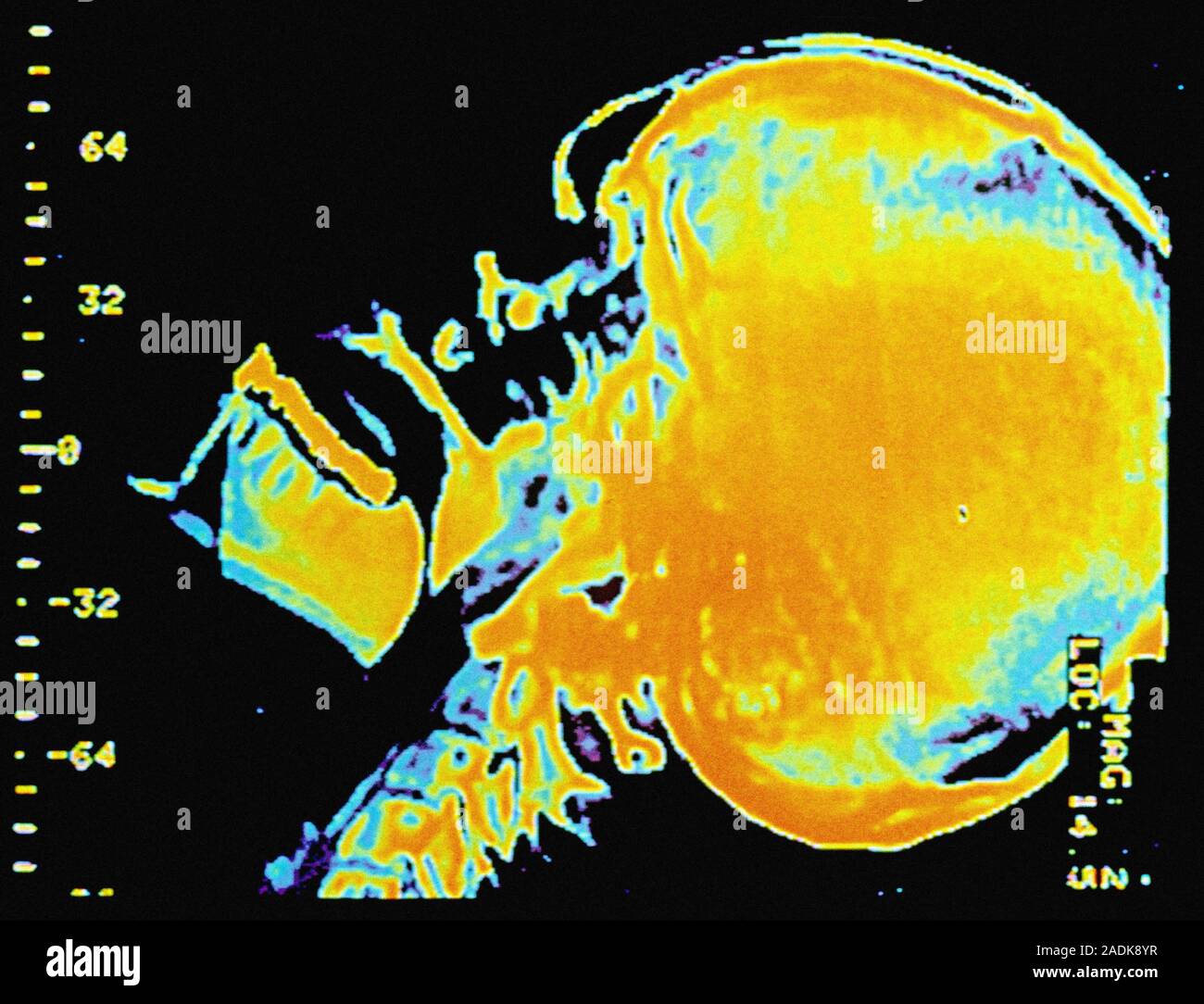 Crâne humain. Numérisation couleur radiographie d'un crâne humain en ...
