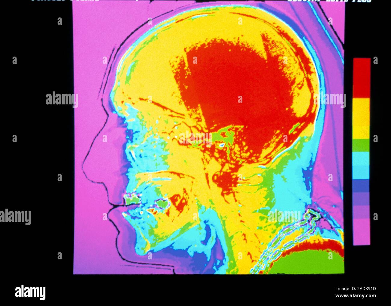 La numérisation du crâne. Couleur scanner à travers un crâne humain en ...