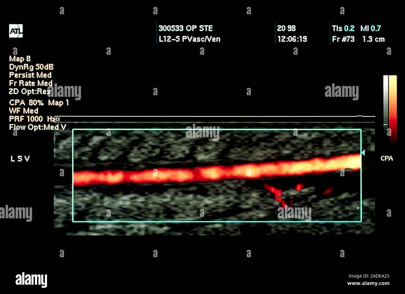 La veine de la jambe. Échographie Doppler de puissance du flux sanguin ...