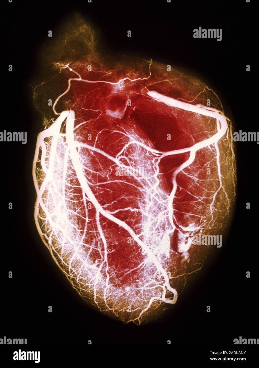 Cœur en santé. Artériogramme couleur X-ray (ou) angiographie montrant ...
