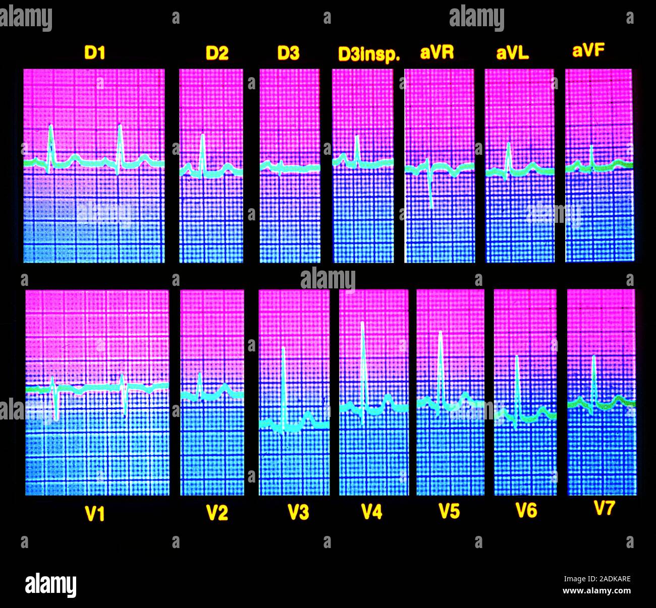 Heartbeat en bonne santé. Électrocardiogramme (ECG) traces montrant la ...