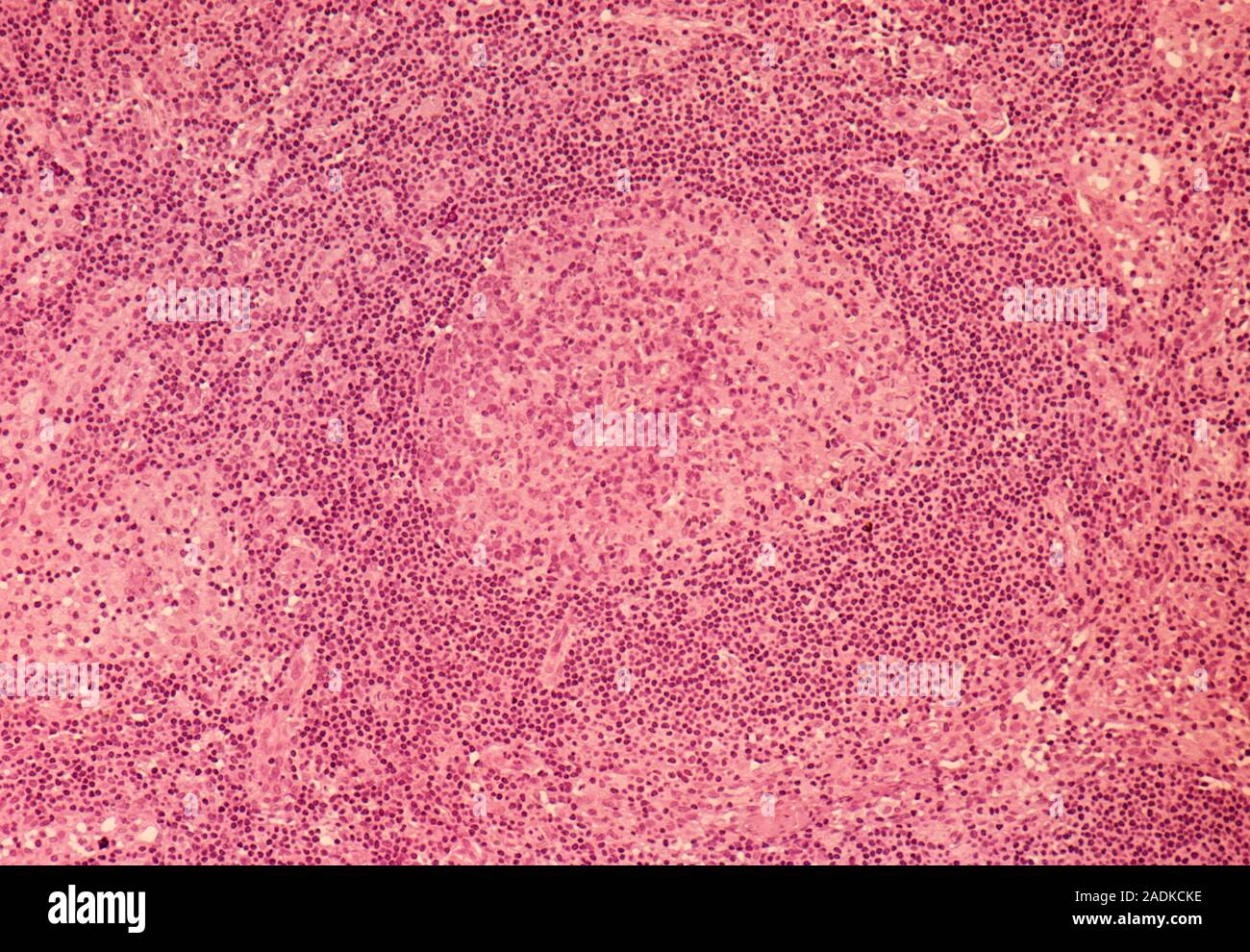 Des follicules lymphoïdes. Microphotographie lumière d'une section par ...