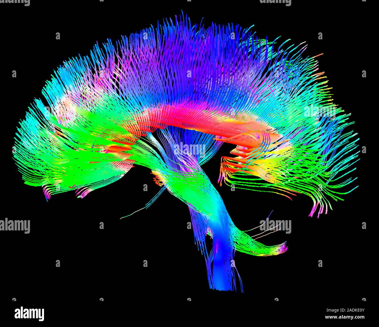 Voies cérébrales. 3 dimensions couleur d'imagerie par résonance ...