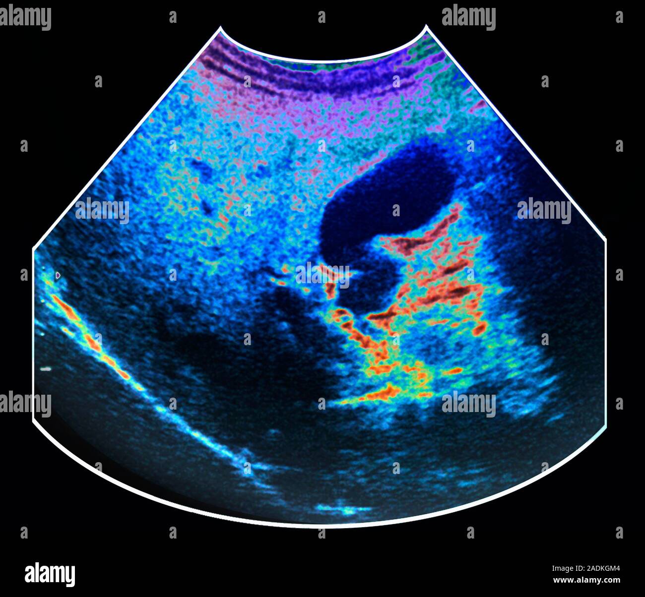 Vésicule biliaire. Échographie de couleur d'une vésicule biliaire saine ...