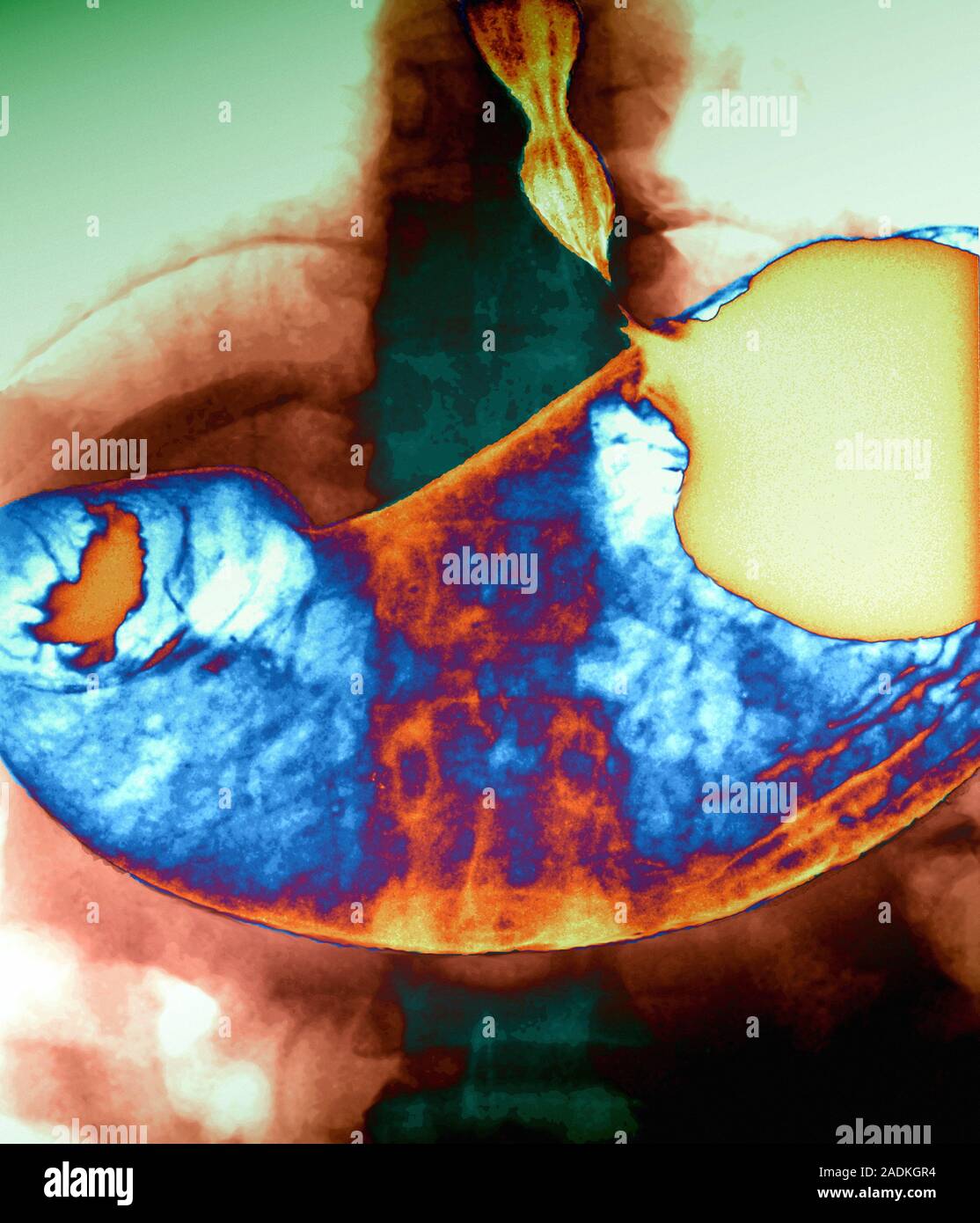 L'estomac. X-ray de couleur d'un repas de baryum (jaune, en haut à ...