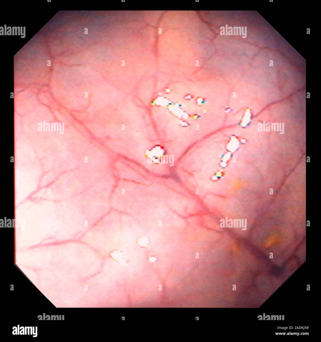 Gros intestin. Coloscope (endoscope) vue sur les muqueuses (muqueuse ...