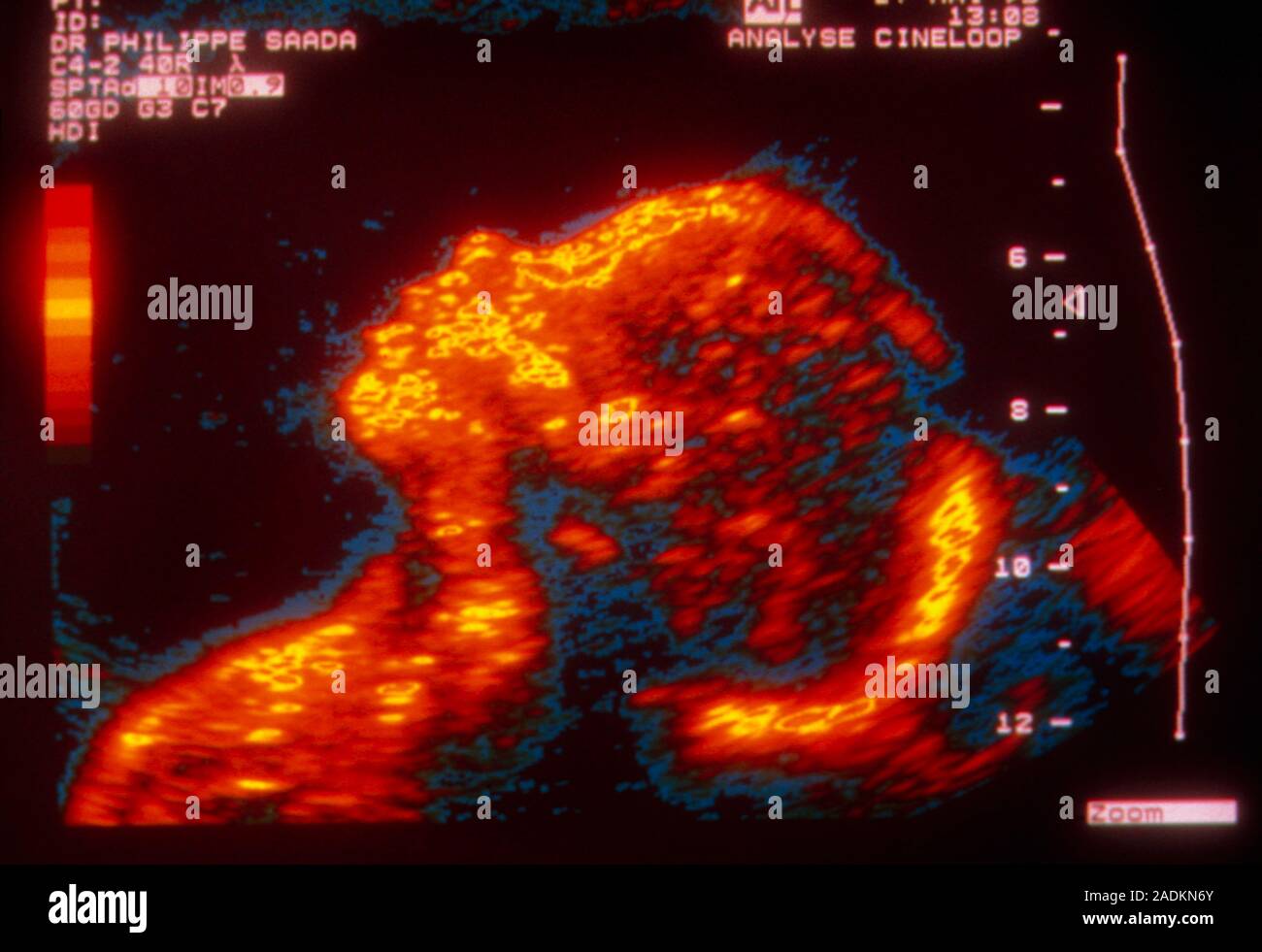 Visage d'un foetus. Échographie Doppler de la tête d'un fœtus humain de ...