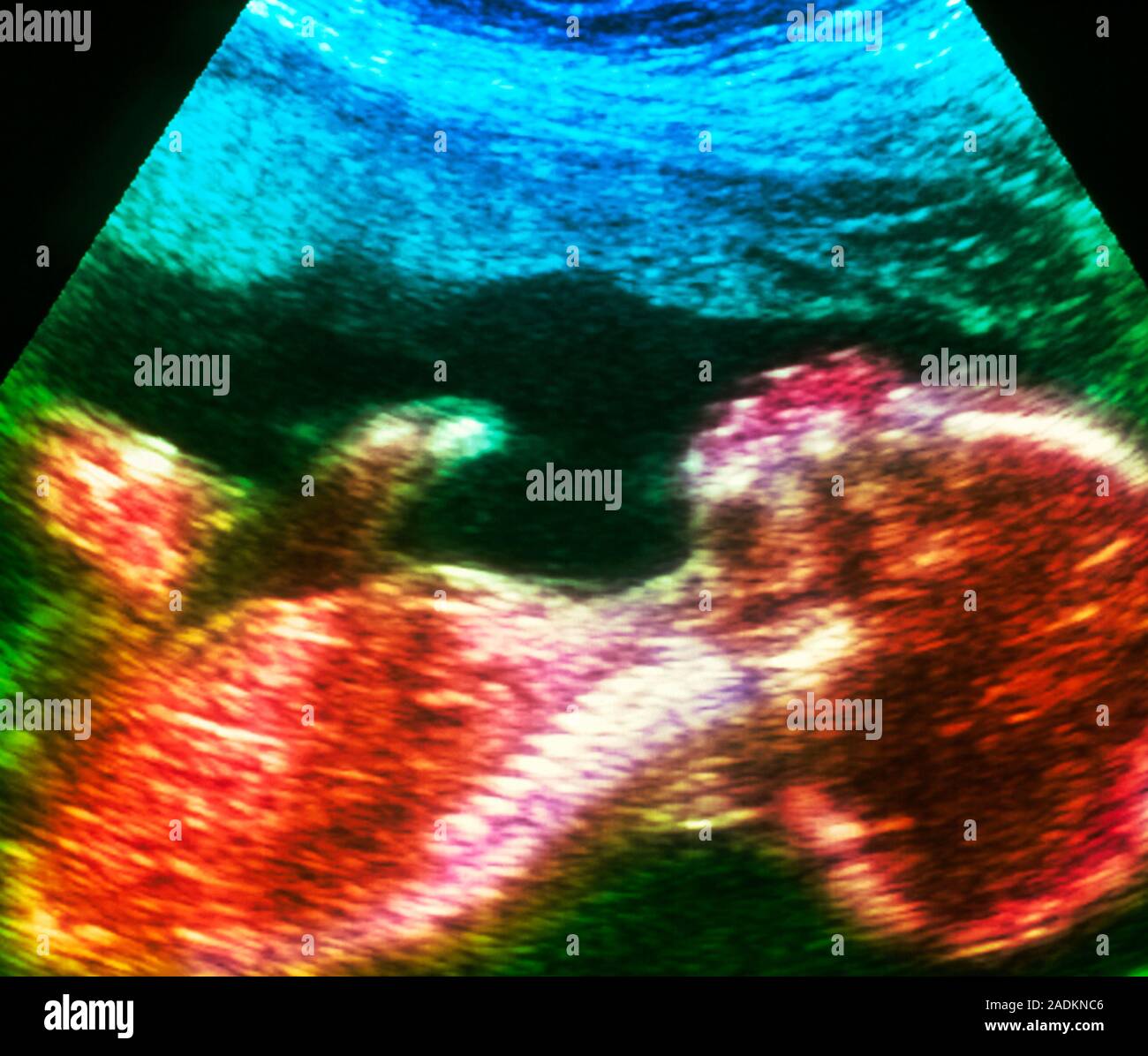 Vingt semaines foetus. Échographie de couleur d'une 20 semaine (cinq ...