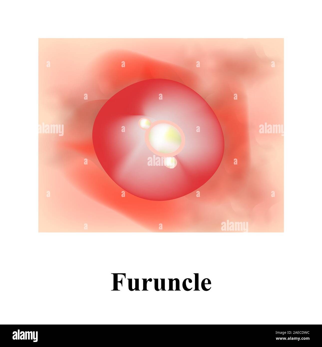 Pustules sur la peau. L'acné kystique. Des boutons sur la peau ...