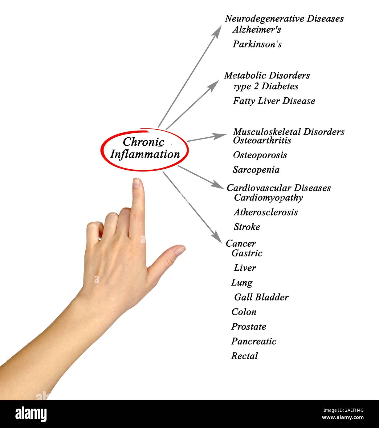 Inflammation rectale Banque de photographies et d’images à haute ...