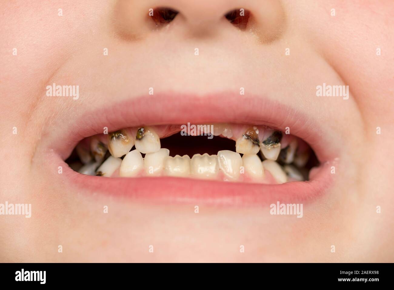 Patient enfant bouche ouverte montrant les dents des caries la carie ...