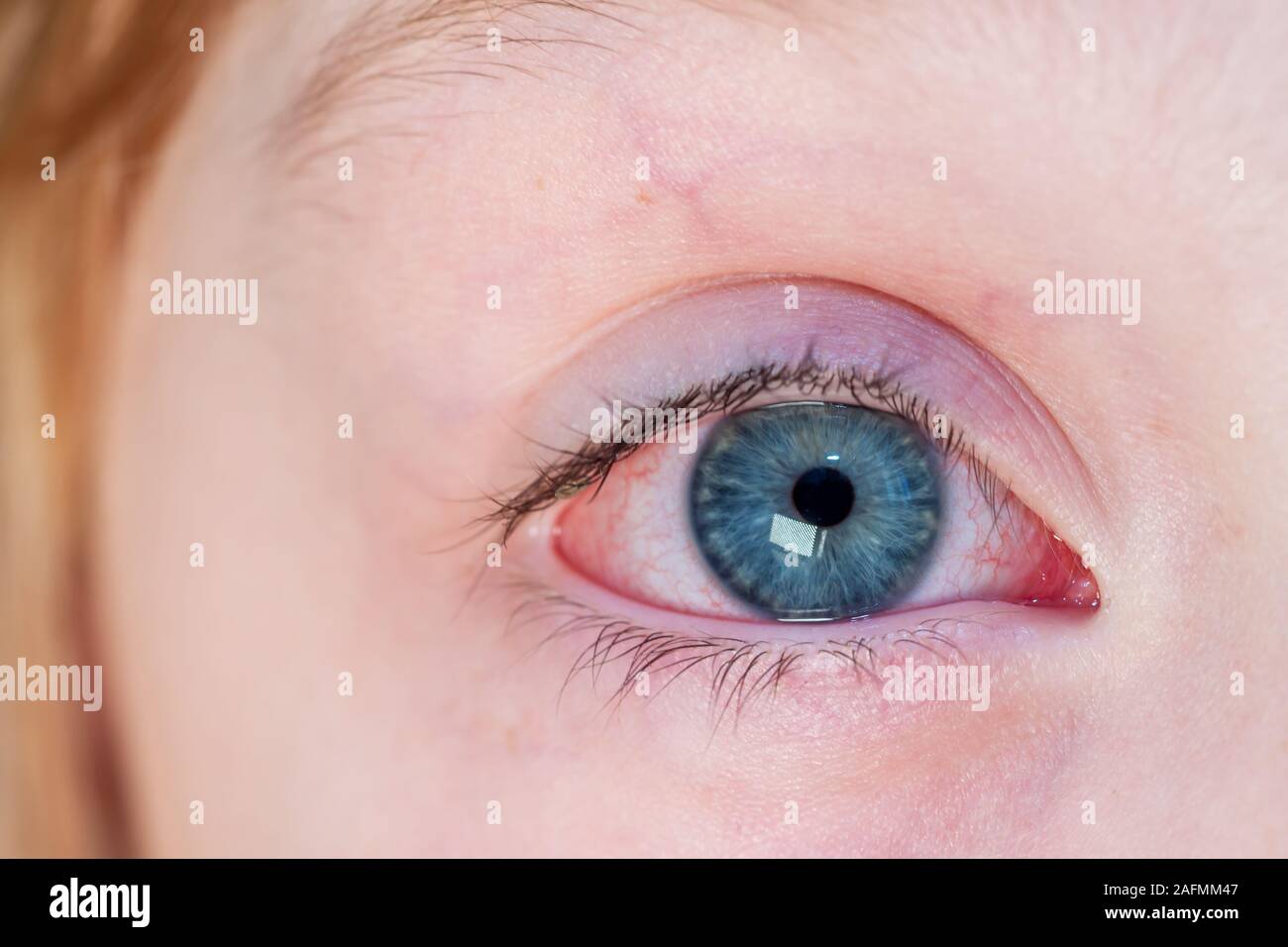 Libre de l'irritation des yeux injectés de rouge - conjonctivite Photo ...