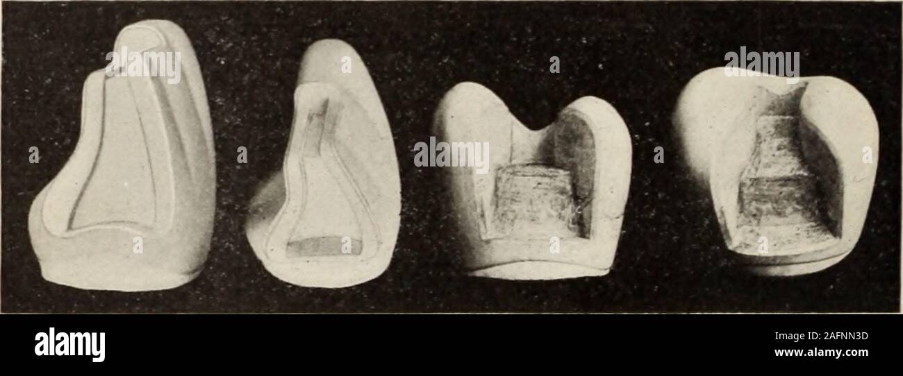 . Résumé de l'émail dentaire.. sera soit rompu par le pluggeror pendant ...