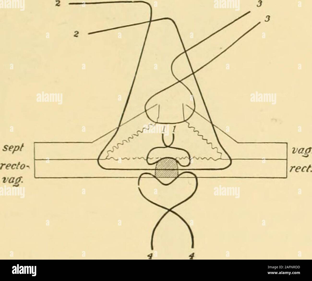 . Gyncology clinique, soins médicaux et chirurgicaux. F, la fistule ...