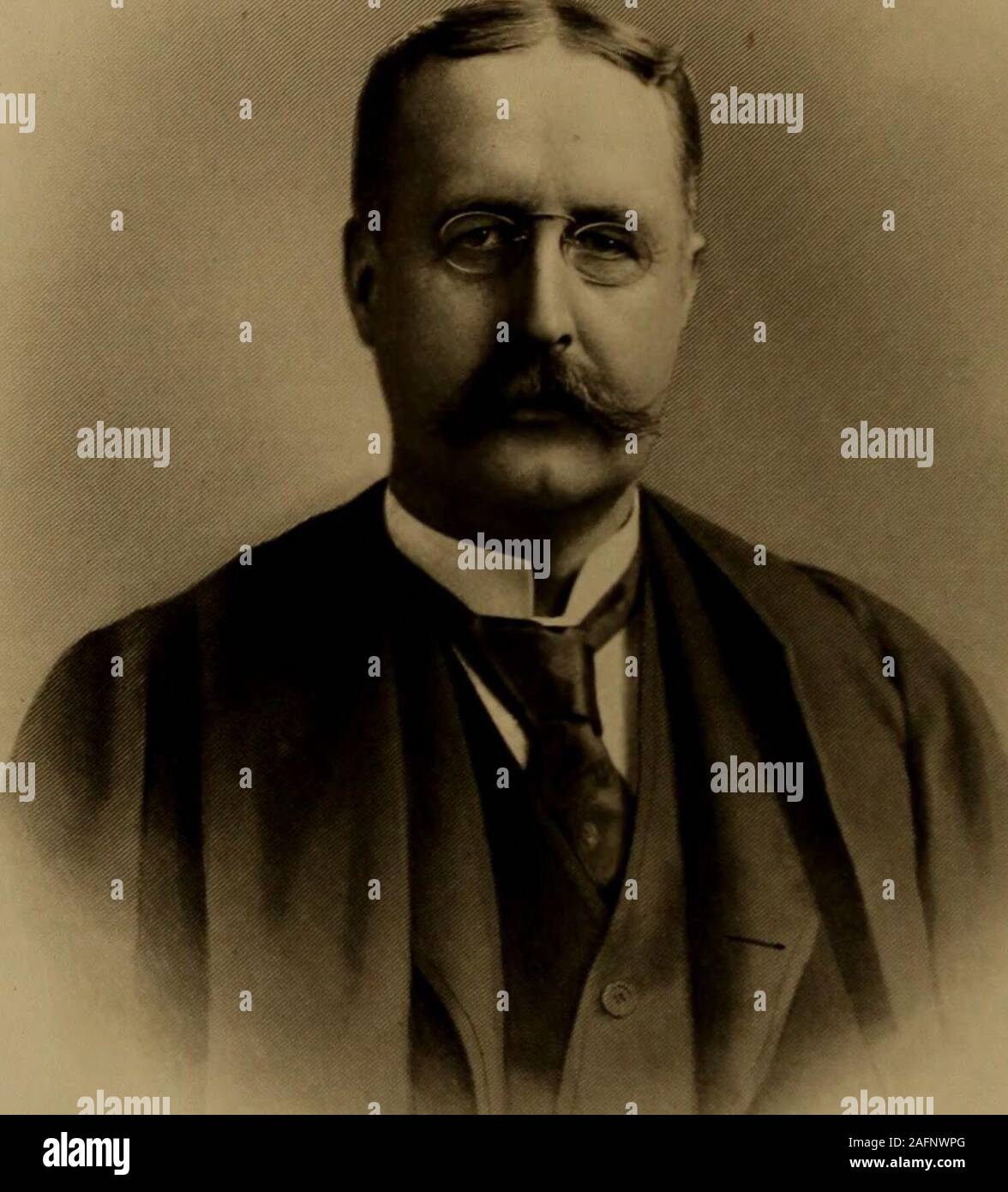 Pulmonary tuberculosis 1899 Banque de photographies et d’images à haute ...