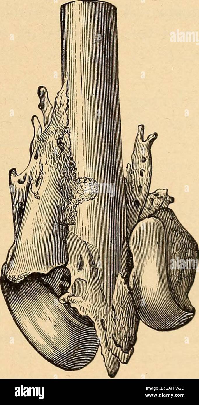 Femur femurs fracture fractures Banque de photographies et d’images à ...