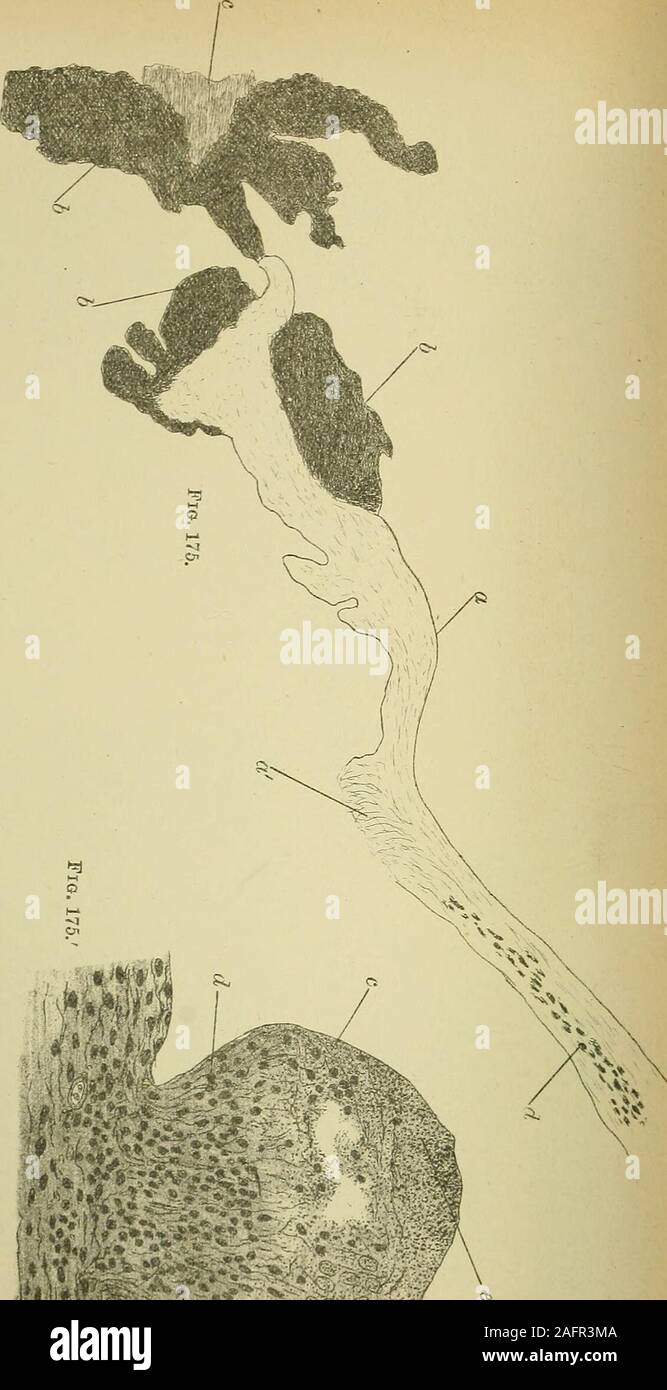 Aorte thoracique Banque de photographies et d’images à haute résolution ...