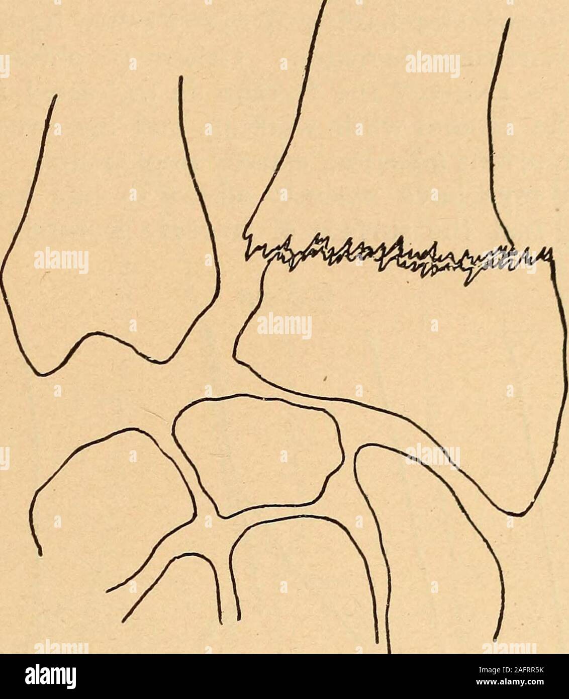 Processus styloïde de l'ulna Banque de photographies et d’images à ...