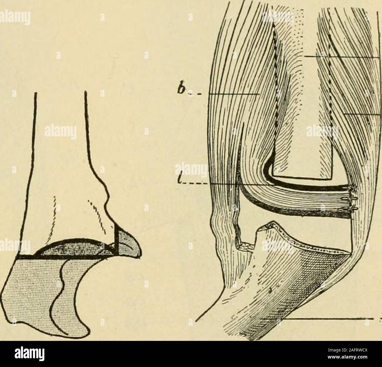 . Manuel de chirurgie opératoire. -.--A Fig. 1377.-{Huguier.) Fig. 1378 ...