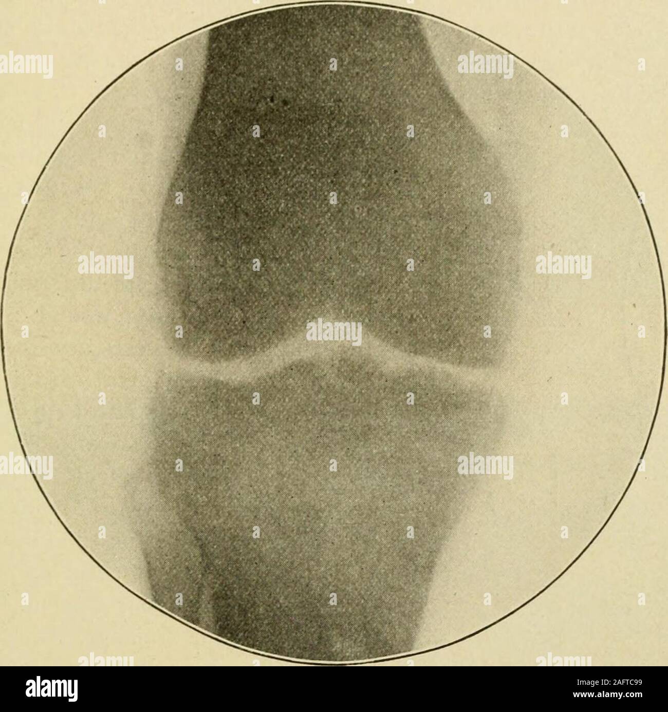 Ligament transverse du genou Banque de photographies et d’images à ...