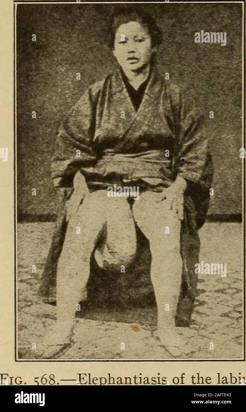 Loa loa filaria Banque de photographies et d’images à haute résolution ...