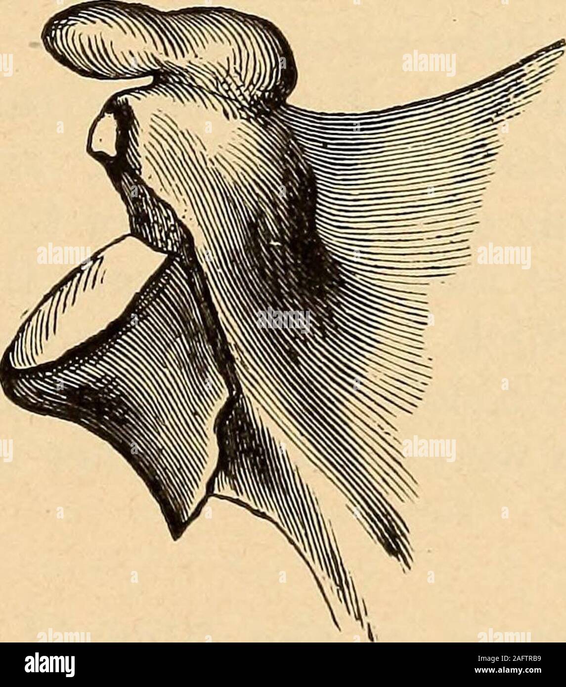 . Un traité pratique sur les fractures et luxations. dos de la scapula ...