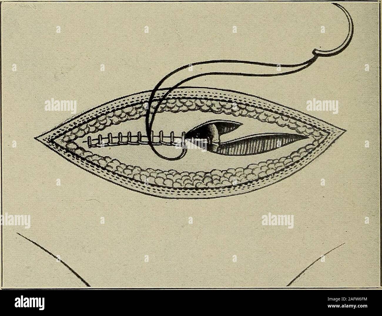 Aponevrose cervicale Banque de photographies et d’images à haute ...