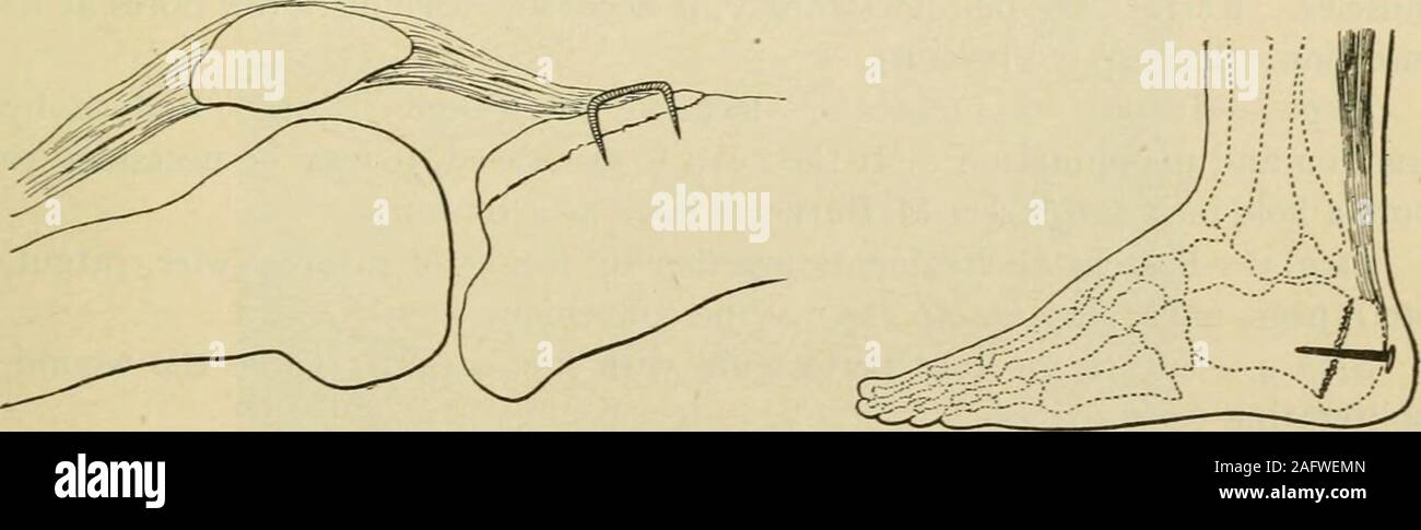 . Manuel de chirurgie opératoire. Fig. 1123.-Fracture du tubercule ...