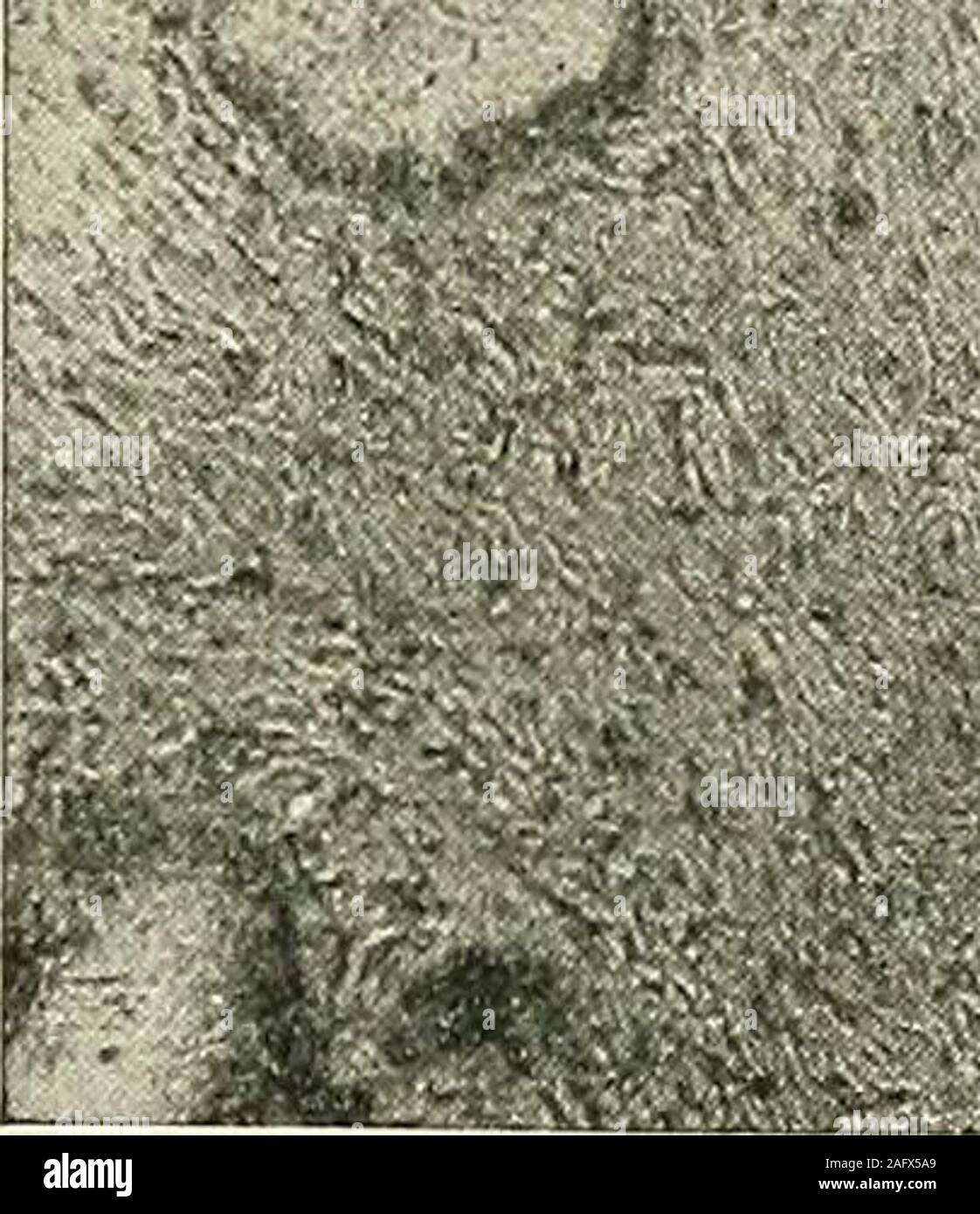 Hypertrophie prostatique Banque de photographies et d’images à haute ...