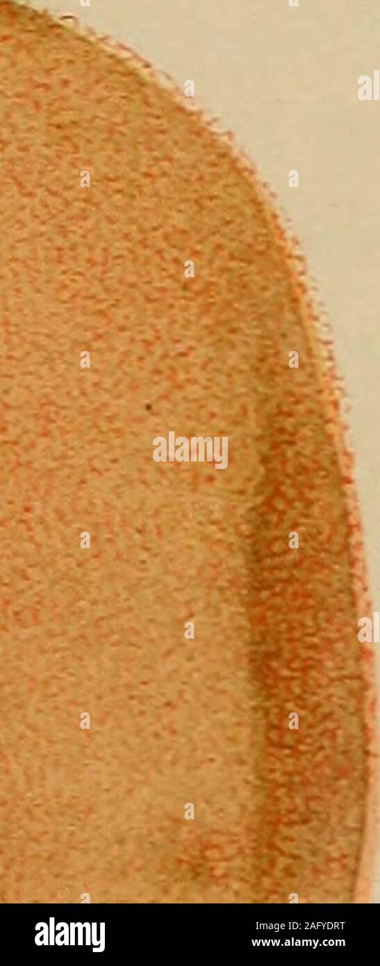 éruption de scarlatine Banque de photographies et d’images à haute ...