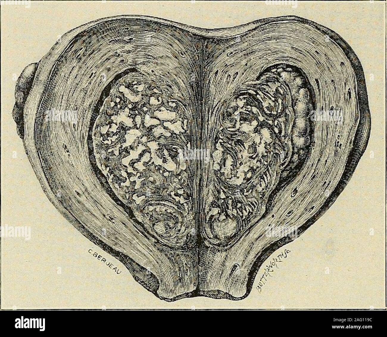 Cavity of the uterus Banque de photographies et d’images à haute ...
