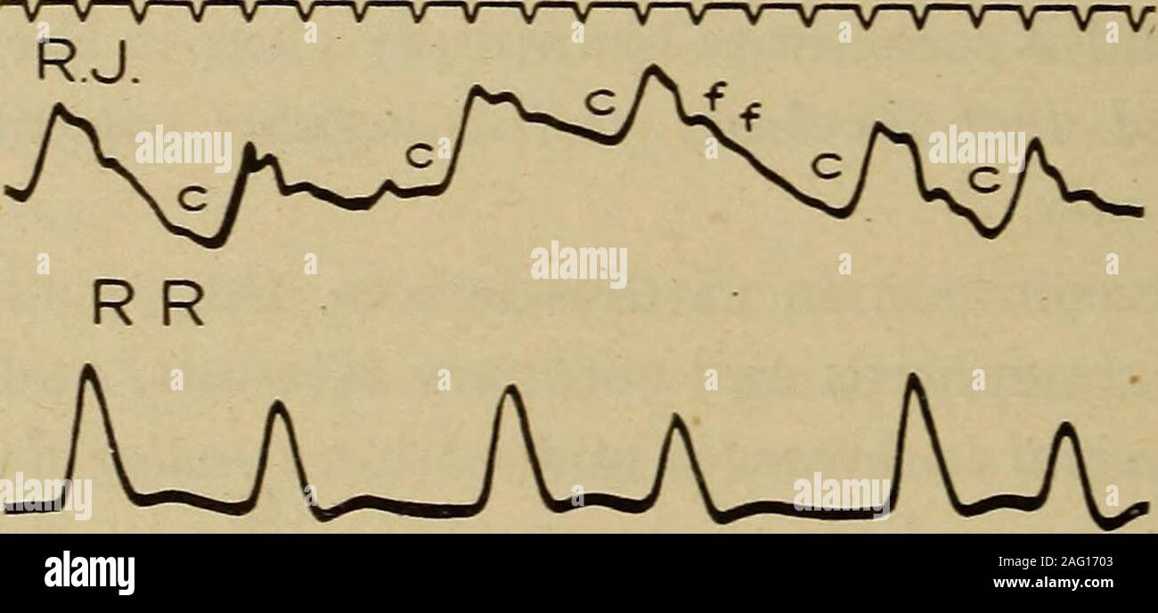 . Diagnostic médical pour l'étudiant et le praticien. Fig. 270.-Pulse ...