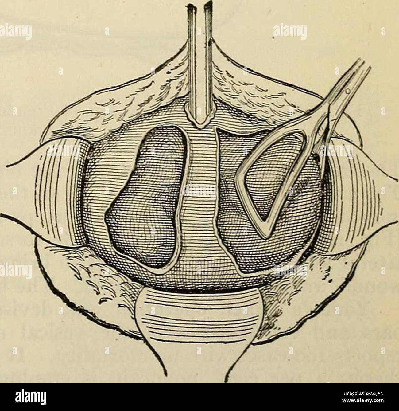 . La chirurgie moderne, général et du dispositif. Fig. 1015.-Tracteur ...
