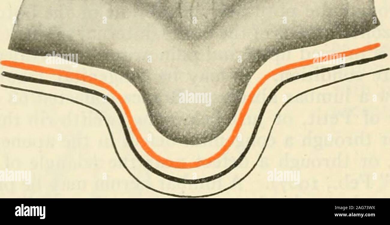 Hernia inguinal femoral Banque de photographies et d’images à haute ...
