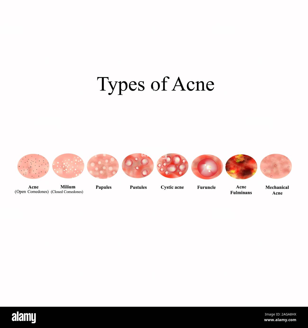 Types d'Acné inflammation de la peau. Boutons, furoncles, Whitehead ...