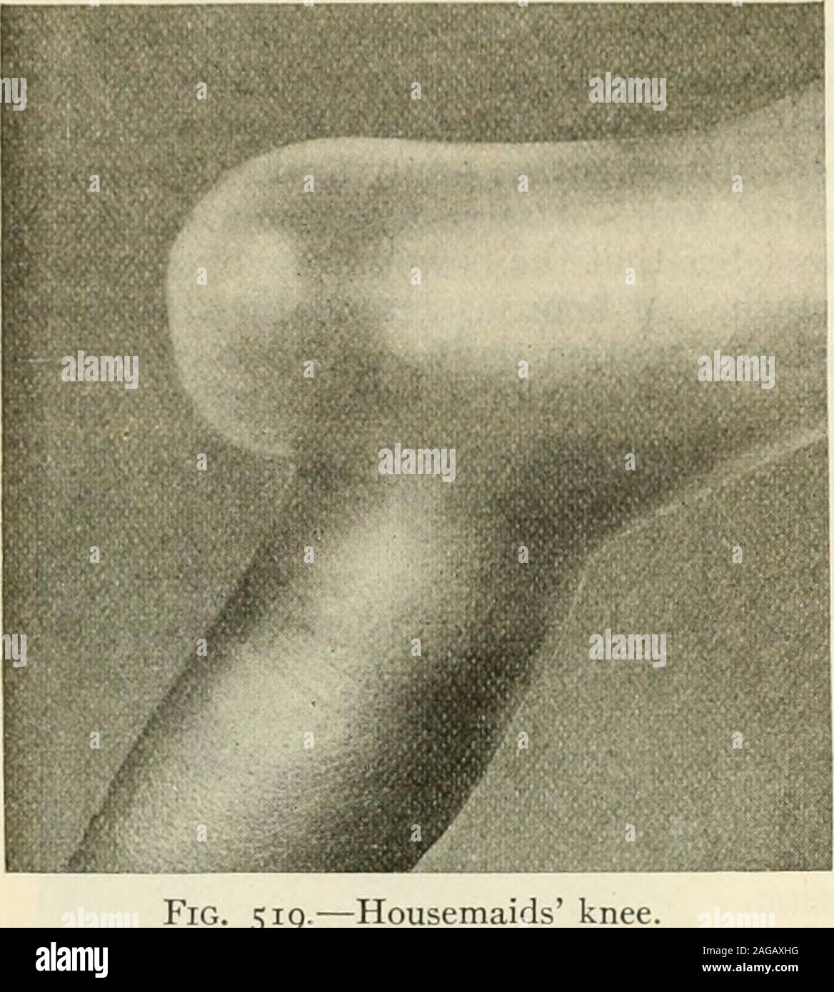 Bursite du genou Banque de photographies et d’images à haute résolution ...