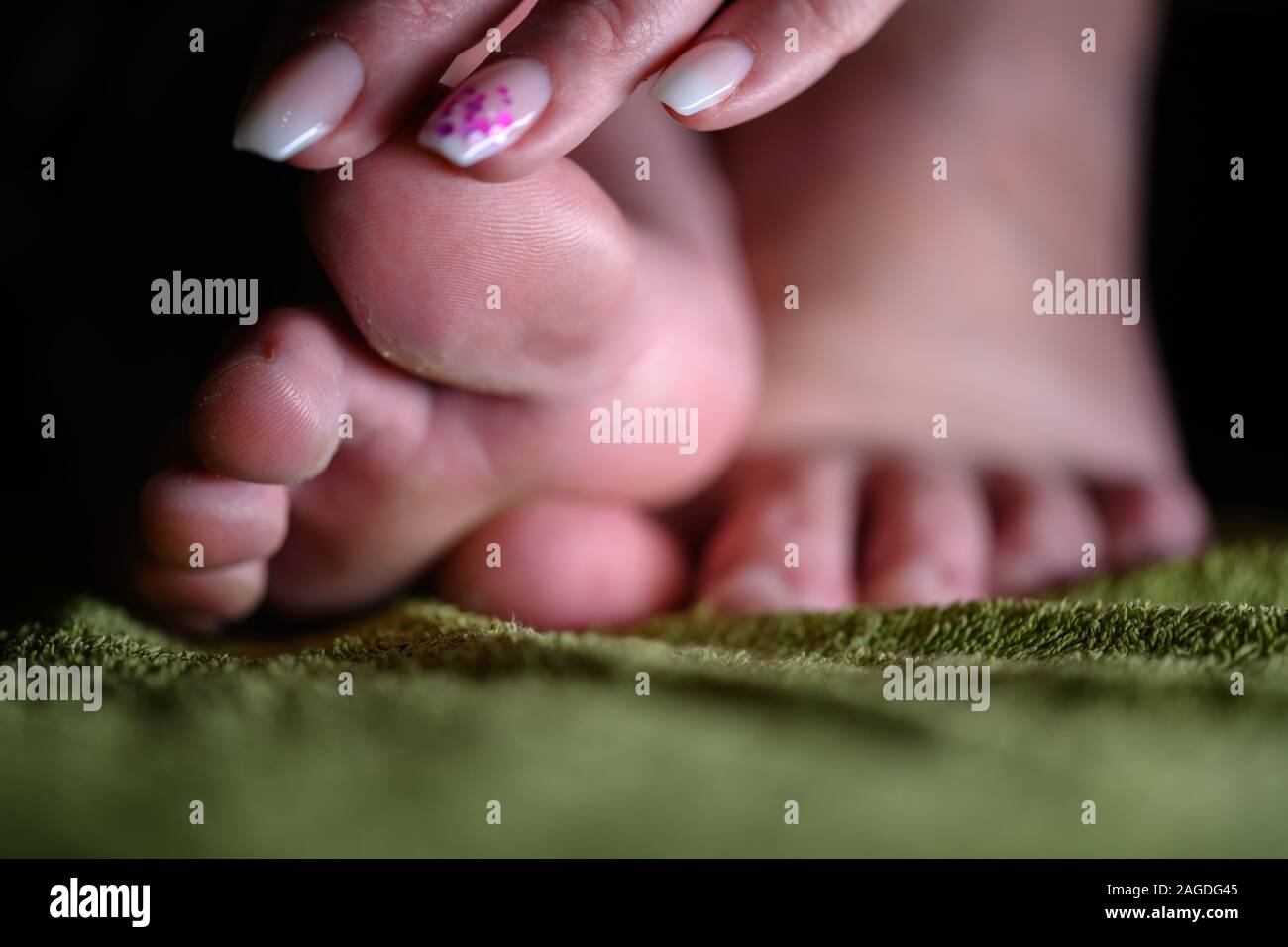 Fungal infection rash tinea on Banque de photographies et d’images à ...