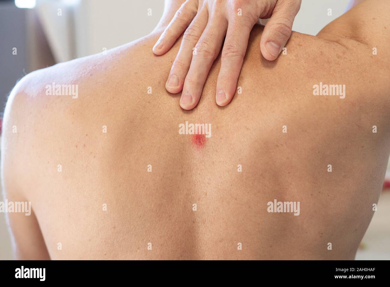 Gros bouton sur la peau Banque de photographies et d’images à haute ...