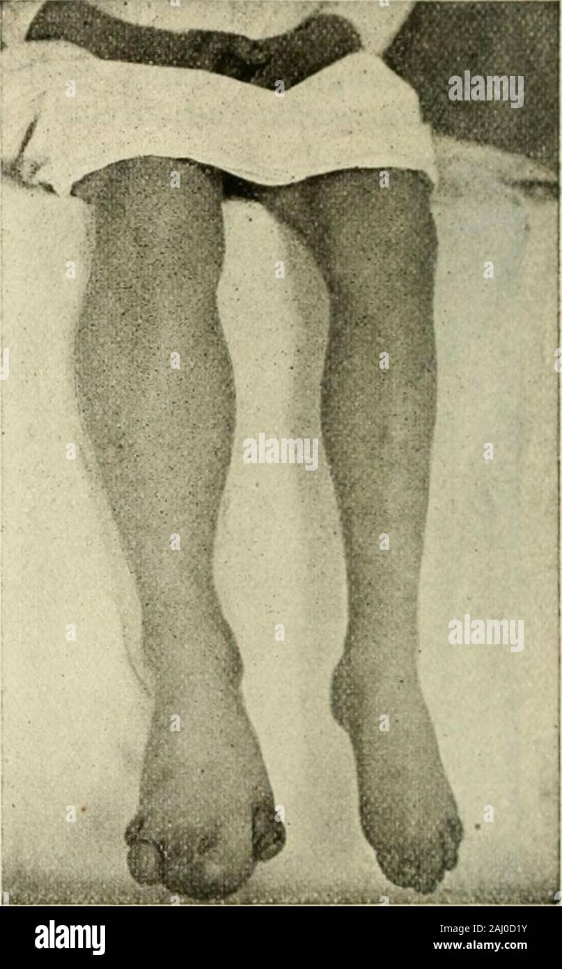La chirurgie moderne, général et du dispositif . Fig. 171.-Lipome de la ...